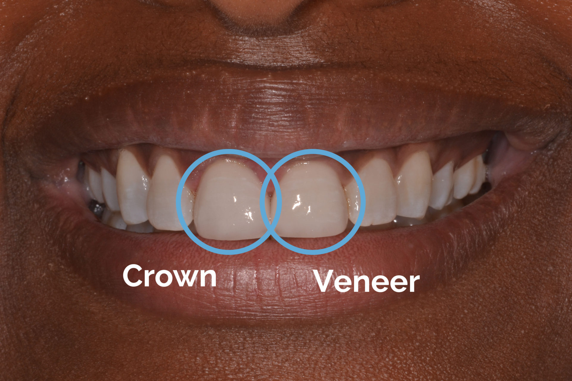 Veneers Vs. Crowns: Understanding the Differences, Benefits, and ...