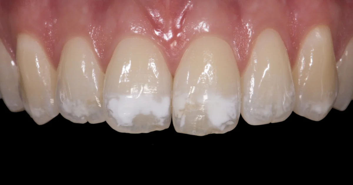 Can White Spots on Teeth Go Away Naturally? + Tips